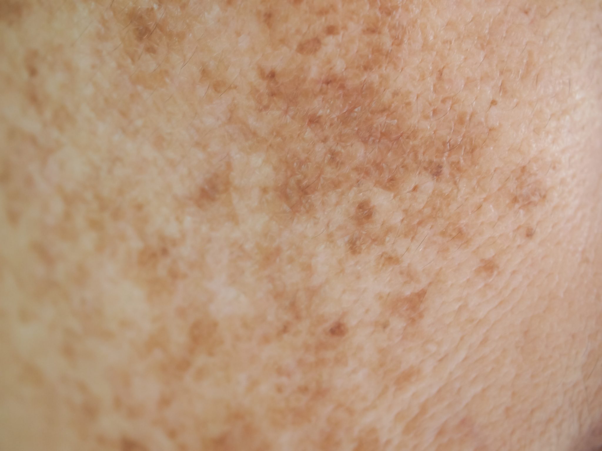 Skin Pigmentation - SJH Derm